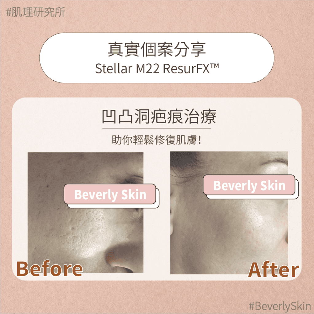 Stellar M22 Resurfx - Beverly Skin